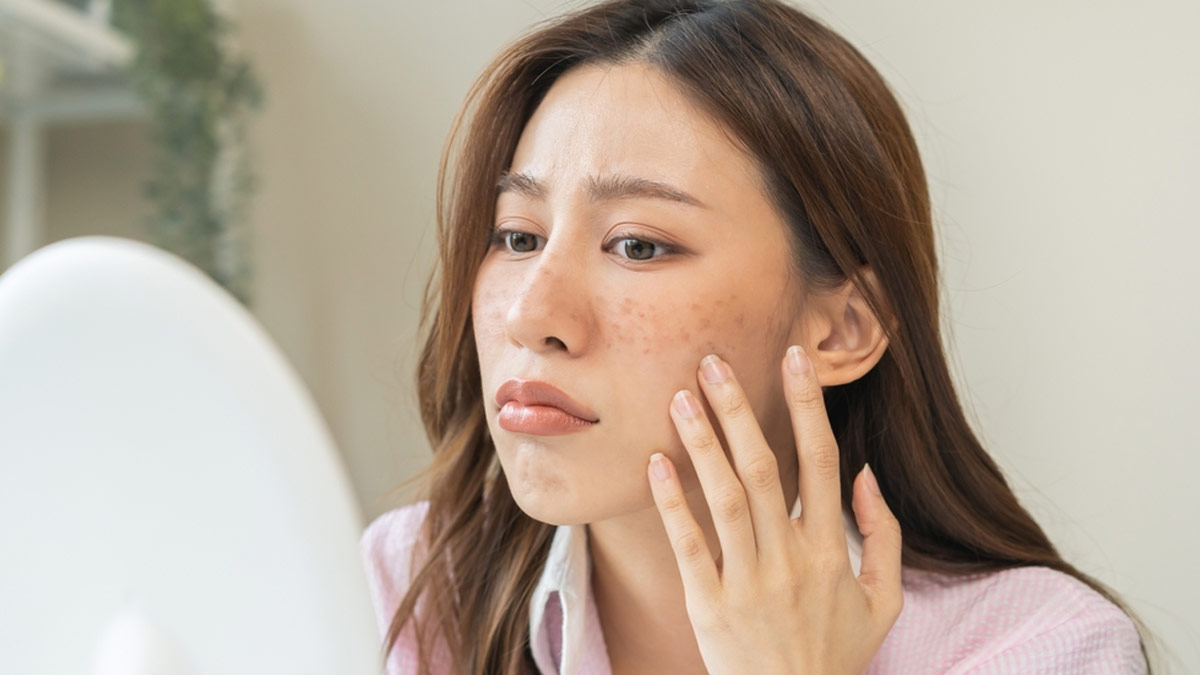 Dark Spots No More Here s How Sesame Oil Can Help You Get Rid Of Them OnlyMyHealth