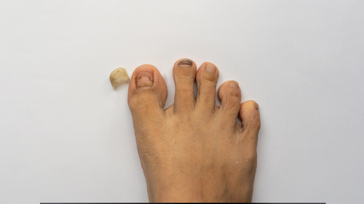 Losing A Toenail Losing A Toenail
