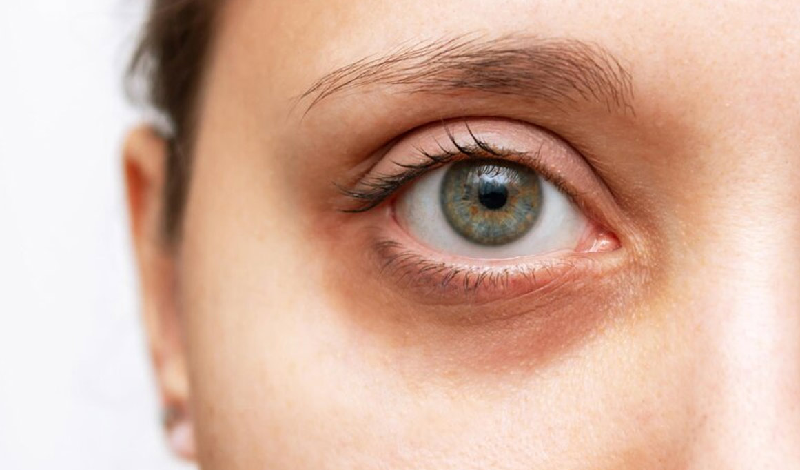 Link Between Iron Deficiency and Dark Circles: Know From Expert ... Link Between Iron Deficiency and Dark Circles: Know From Expert ...