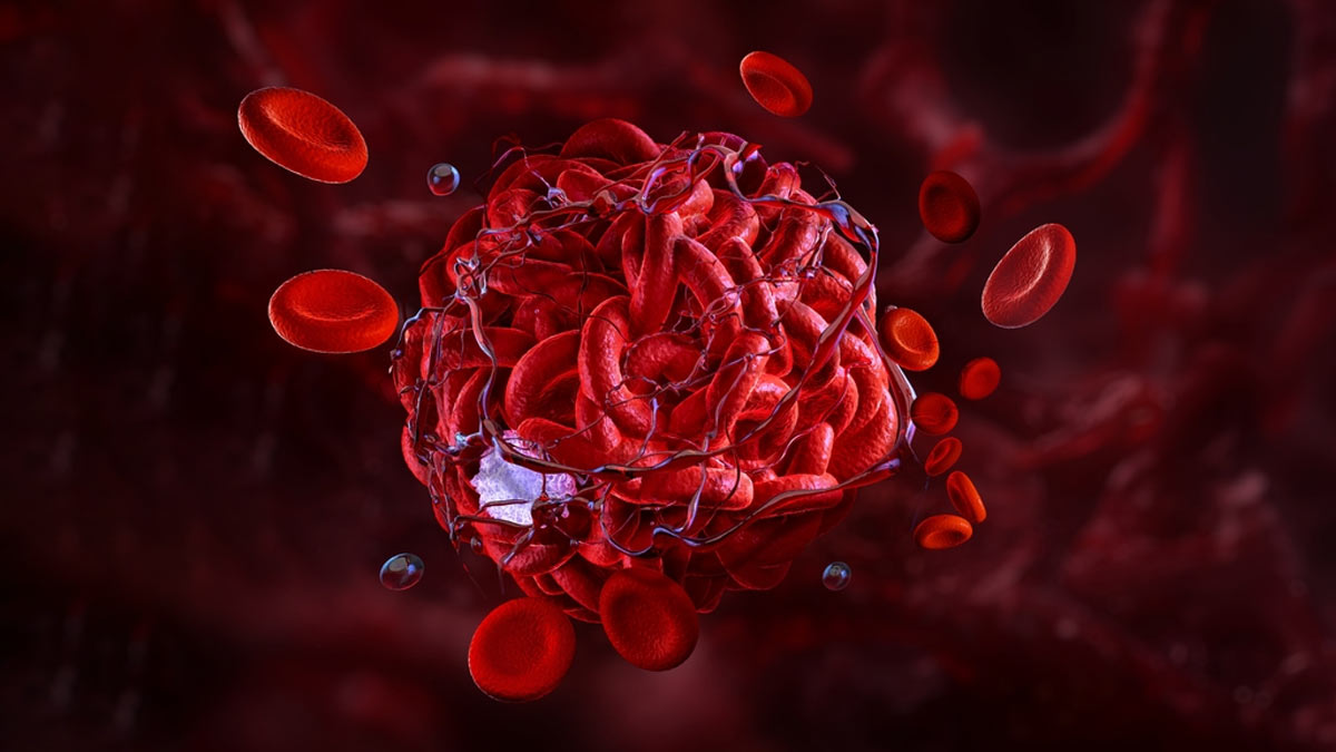 Swelling, Pain, Redness, and More: Expert Explains Thrombosis and Its ...