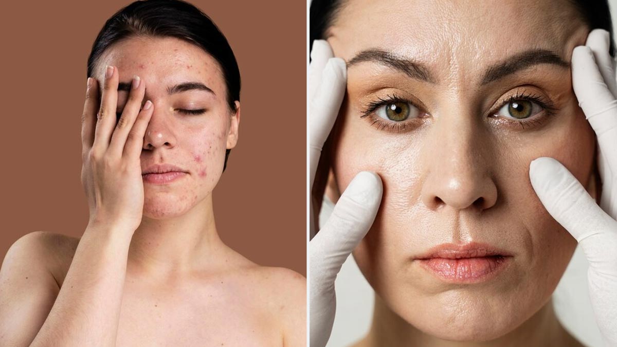 Does Having A History Of Acne Predict Better Ageing And Fewer Wrinkles ...