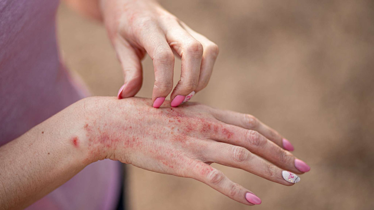 From Oozing Blisters To Red Patches; Telltale Signs Of Contact ...