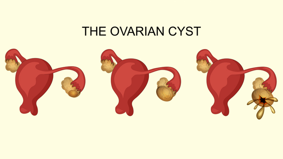 Ruptured Ovarian Cysts: What They Feel Like And How to Deal With Them ...