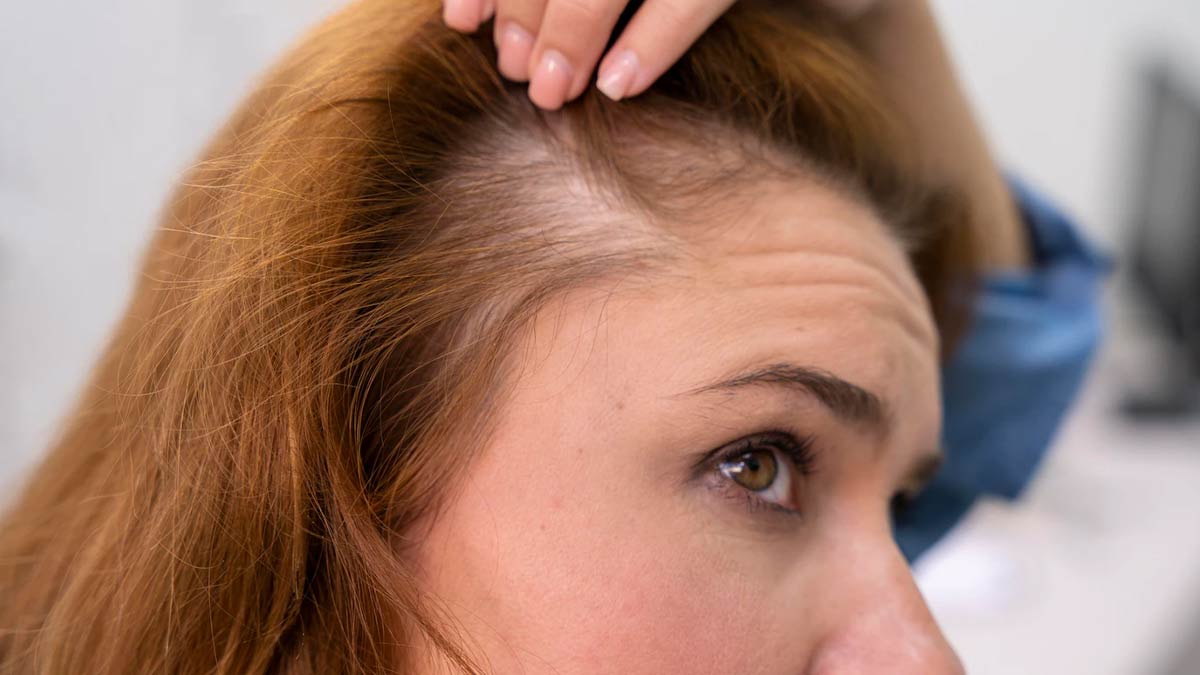 What Is Patterned Hair Loss in Your 20s? Expert Shares Treatment And ...