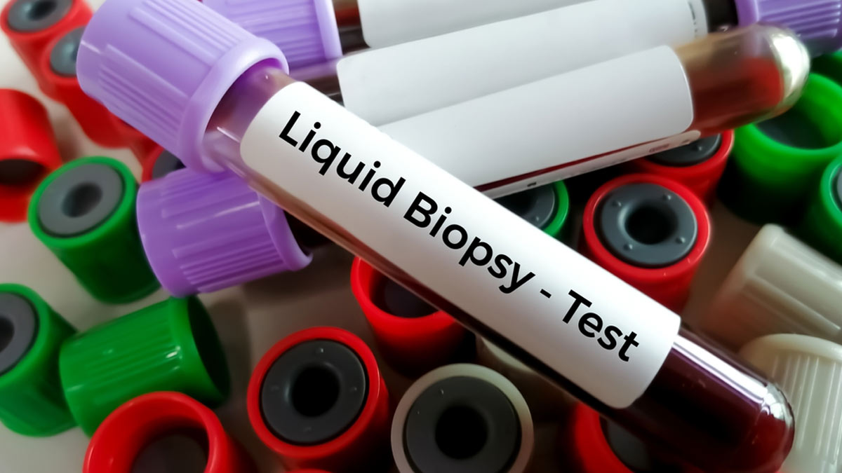 Liquid Biopsy: Expert Explains How This Non-Invasive Technique Helps Detect Cancer Early ...