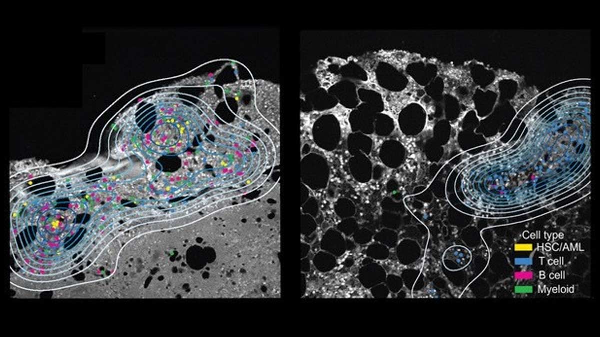 Immune Cells Found To Boost Cancer Treatment In Acute Leukemia: Study ...