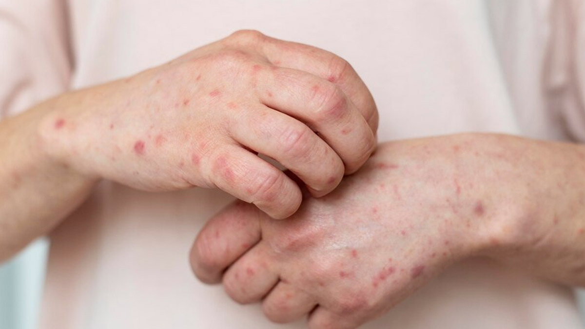 Why People Do Not Get Chickenpox Twice: Management Tips For First ...