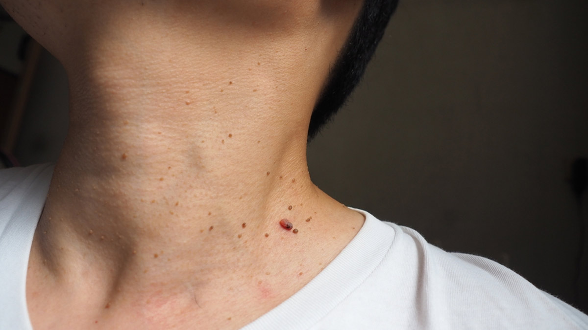 Why Some People With Diabetes Develop Skin Tags | OnlyMyHealth