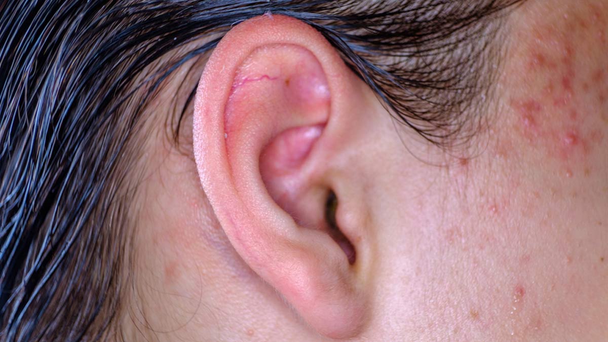 Why Do Pimples Form In Your Ear? Dermatologist Explains Tips To Get Rid ...