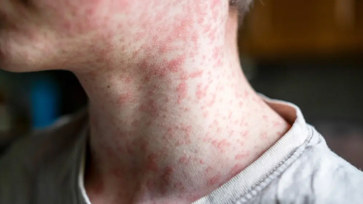 Measles Outbreak In Texas Hits 48 Cases, Worst In 30 Years | OnlyMyHealth