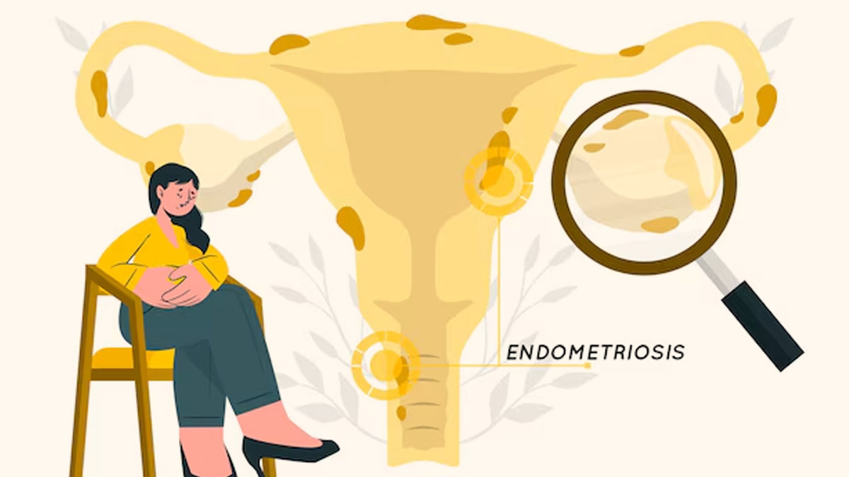 IVF And Endometriosis: How To Manage Symptoms And Improve Success Rate ...