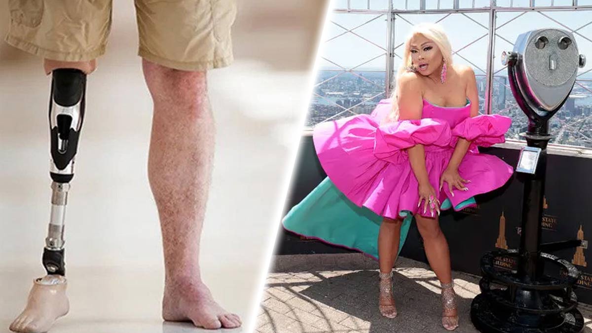 What Is Leg Amputation? Exploring How Infection Following Removal Of A ...