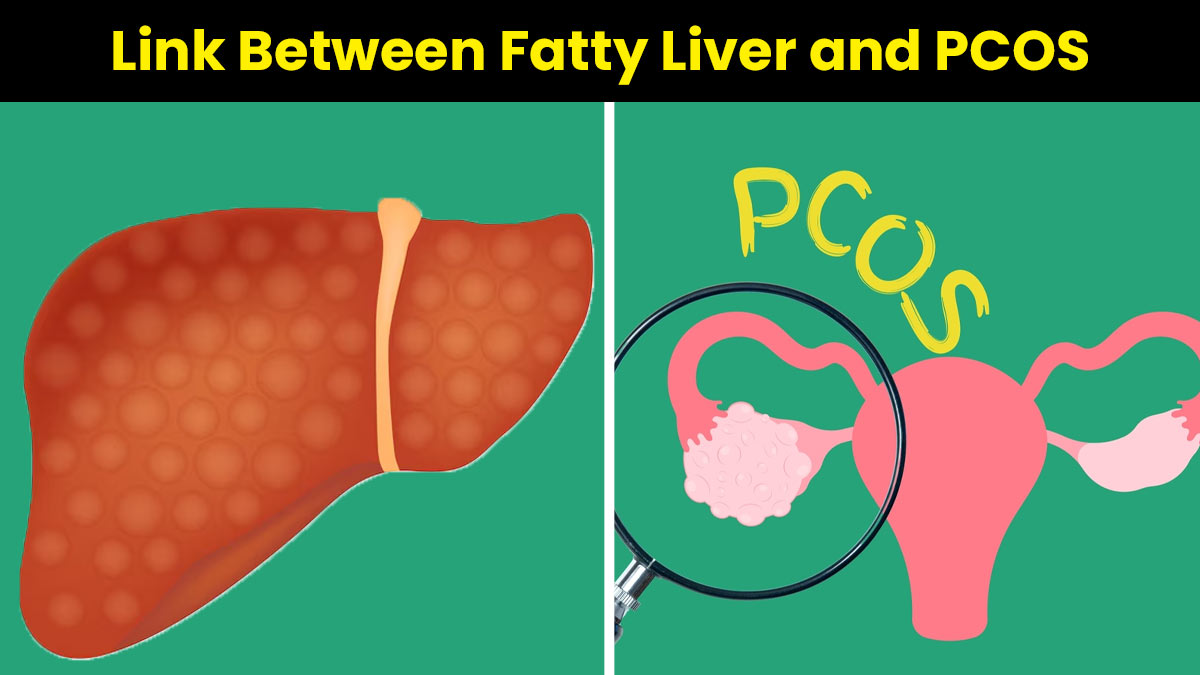 Fatty Liver And PCOS: The Hidden Hormonal And Metabolic Link That You ...