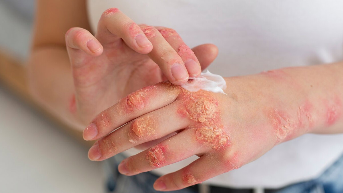 Showering Tips For Atopic Dermatitis: What A Dermatologist Wants You To ...