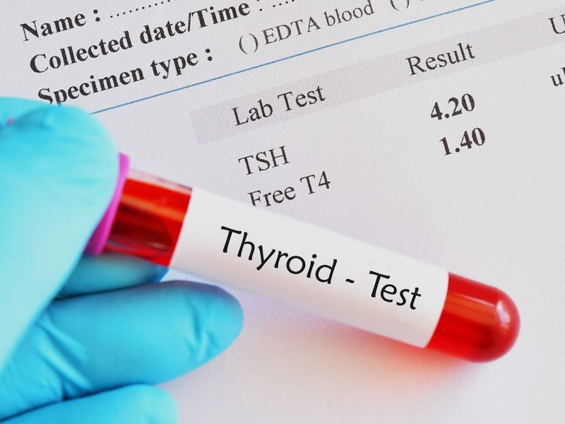 What Is Thyroid Stimulating Hormone Test? Here' When You Need One ...