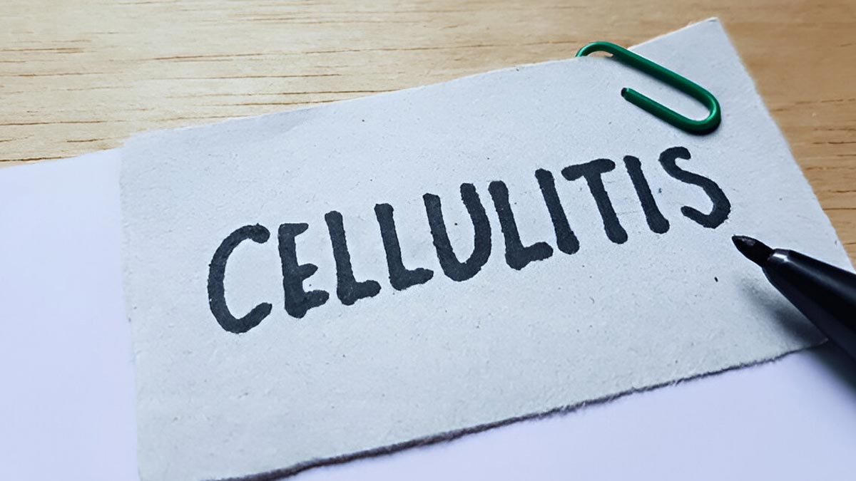 Cellulitis In Summer: Expert Explains Why Skin Infections Spike In ...