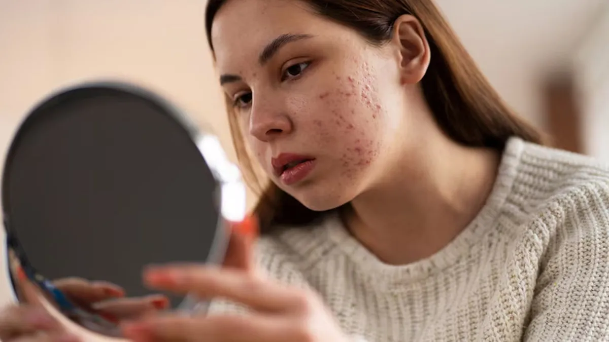 Struggling With Facial Skin Problems After Pregnancy Dermat Tells What Struggling With Facial Skin Problems After Pregnancy Dermat Tells What