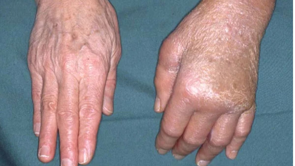 What is CRPS? The Rare Pain Syndrome Archana Puran Singh Developed ...