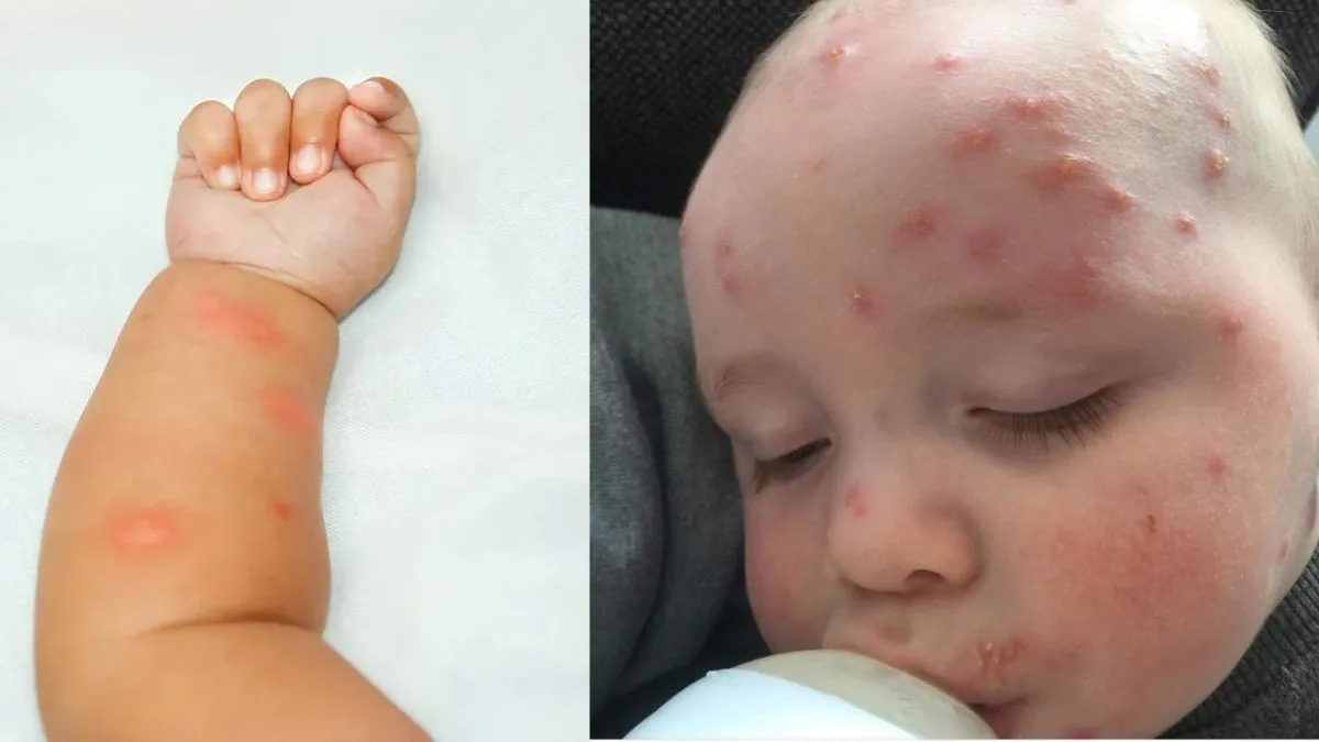 Are Babies Immune to Mosquito Bites? What’s the Best Way to Treat Them ...