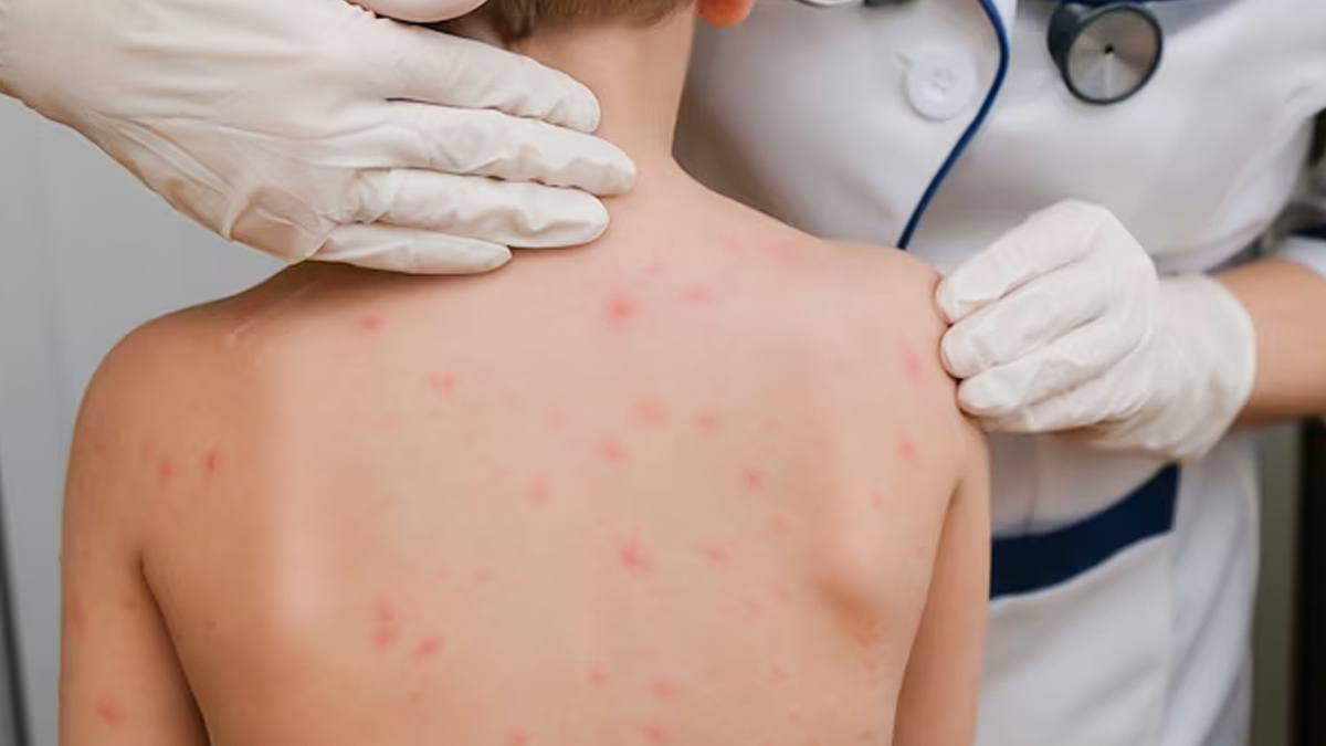 5 Best Vegetables for Chickenpox Prevention: A Doctor-Recommended Diet ...