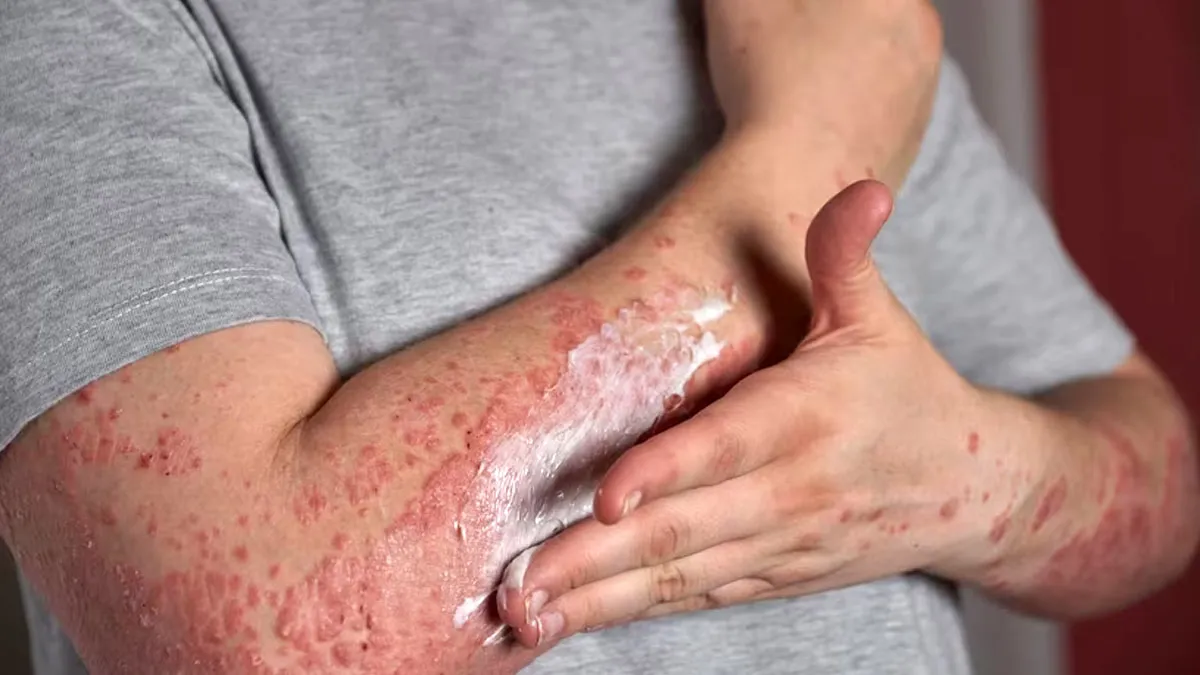 Skin-Brain Axis: How Chronic Stress Shows Up as Eczema and Psoriasis ...