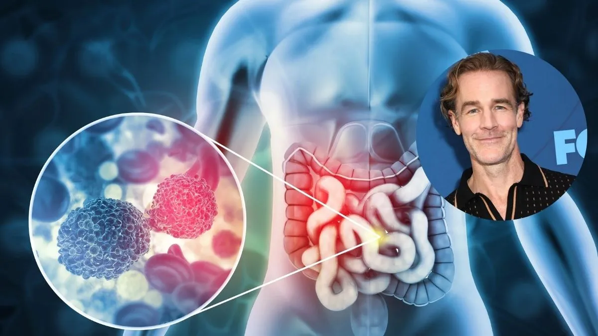 What is Colorectal Cancer? Exploring James Van Der Beek’s Death Cause ...