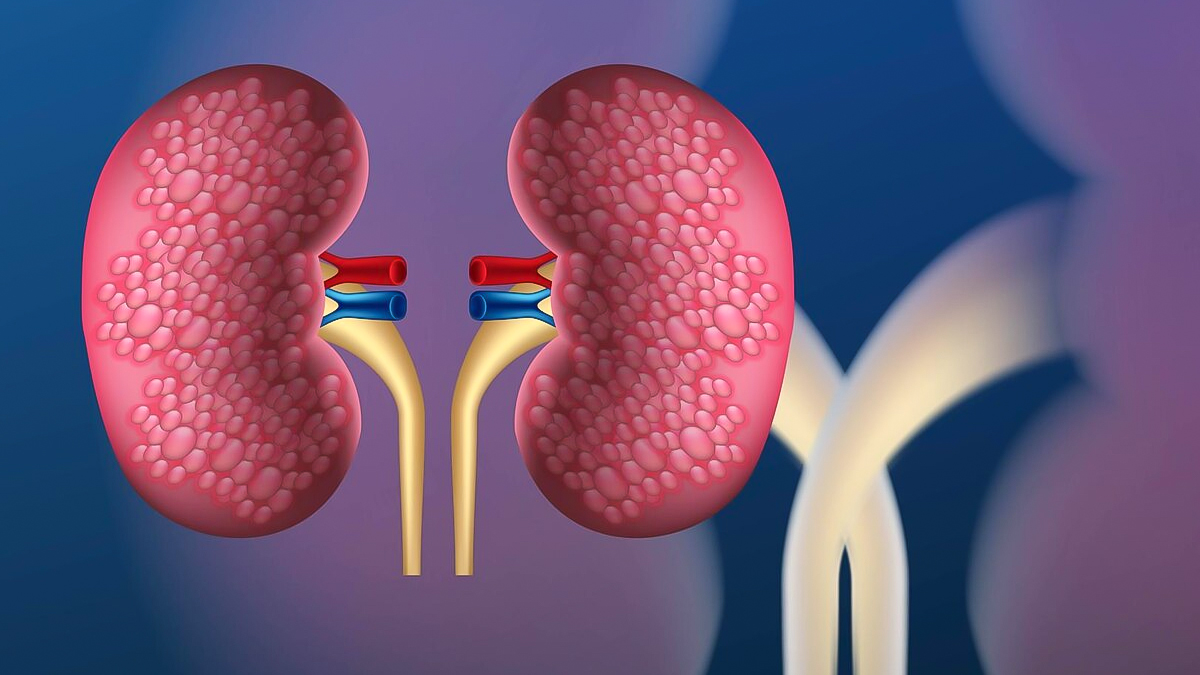 Chronic Kidney Disease Explained: Understanding the 5 Stages and Their ...