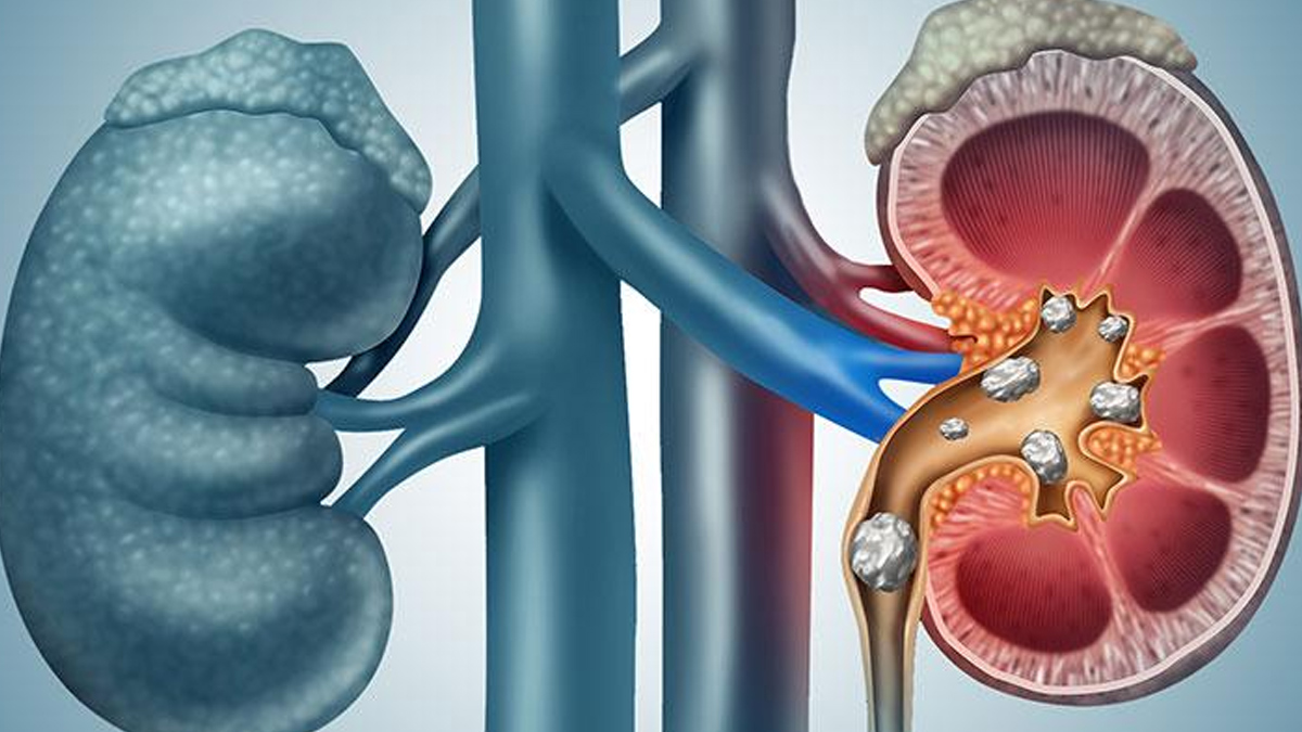 Can Kidney Stones Be Fatal? Warning Signs, Complications, And When To ...