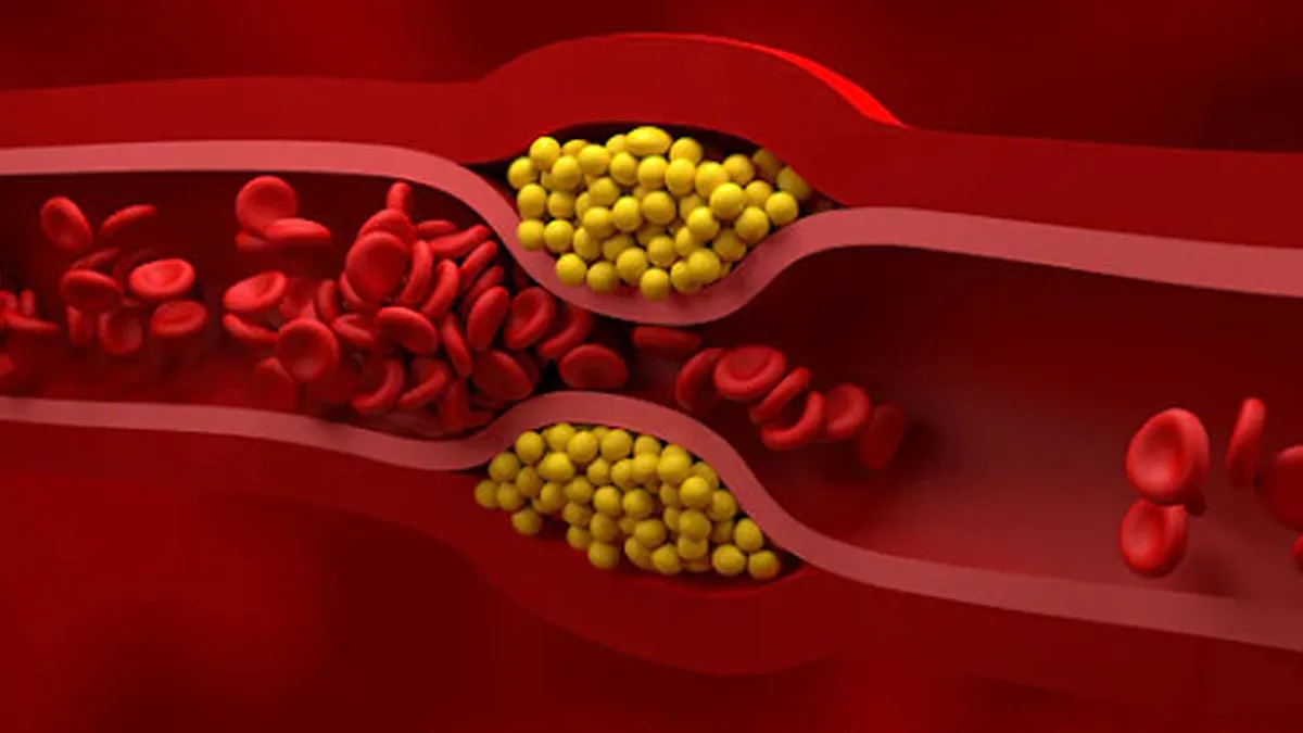 Triglycerides Guide: What They Are and How to Lower Them | OnlyMyHealth