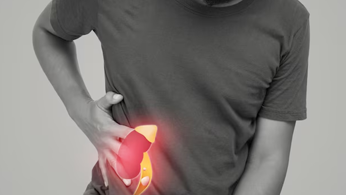 Surgical Options for Kidney Stones: A Complete Guide | OnlyMyHealth