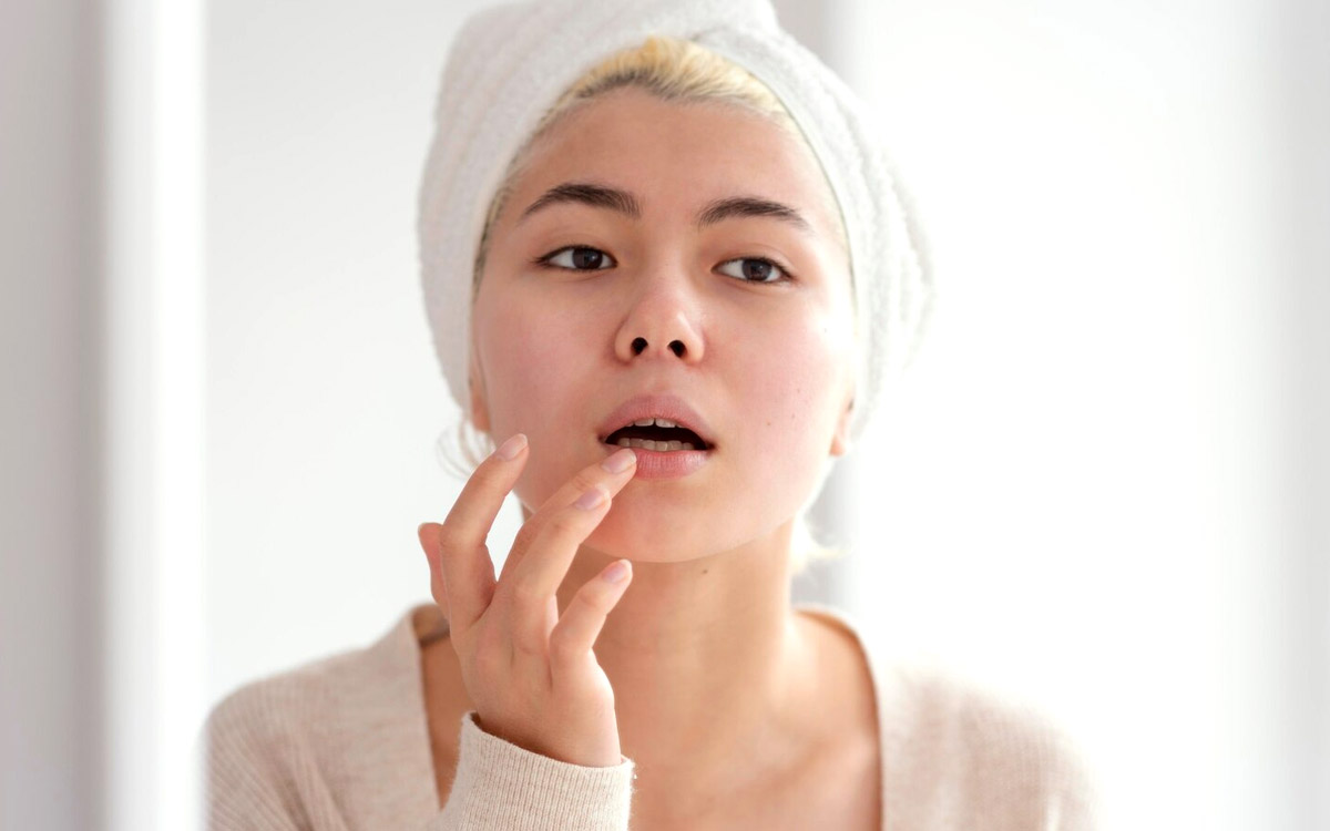 Chapped Lips: Expert Tips to Heal Dry, Cracked Lips Fast | OnlyMyHealth