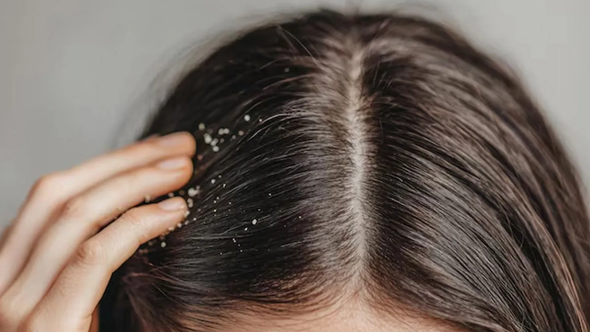 Can Severe Dandruff Cause Pimples On Face? Dermatologist Explains ...