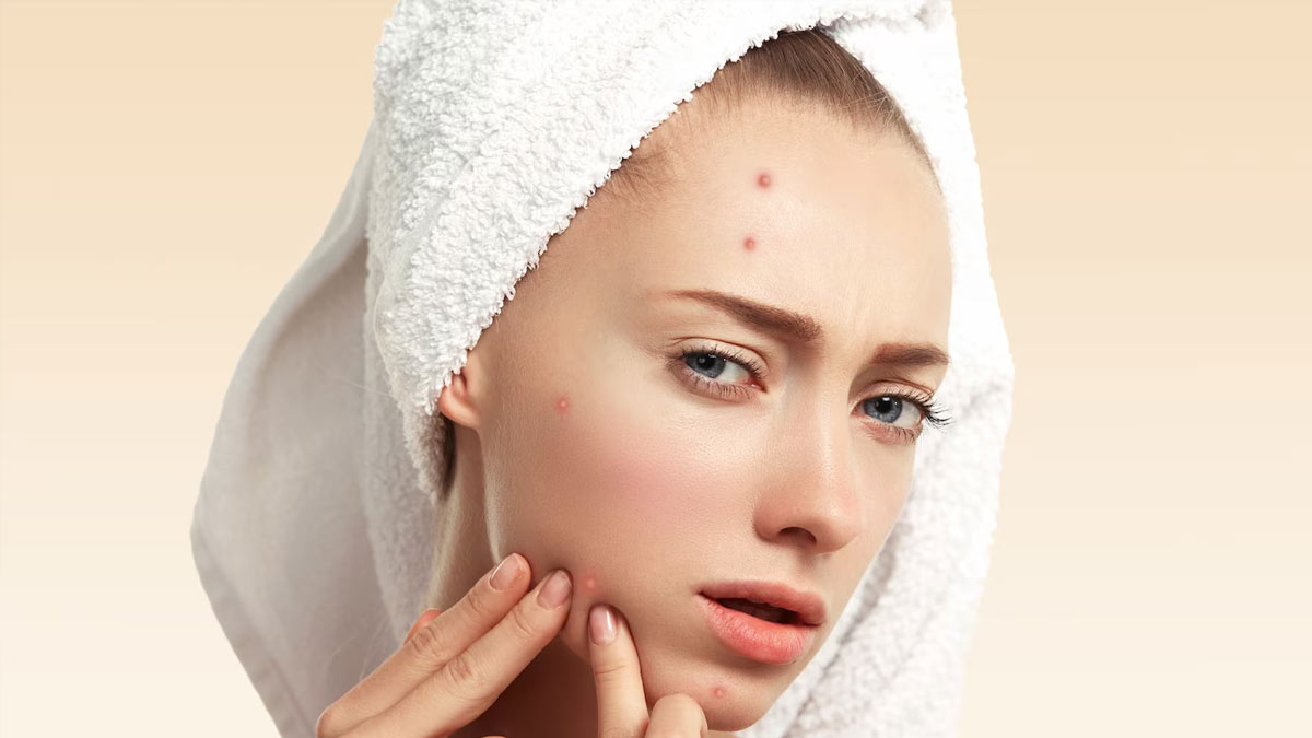 Can Severe Dandruff Cause Pimples On Face? Dermatologist Explains ...