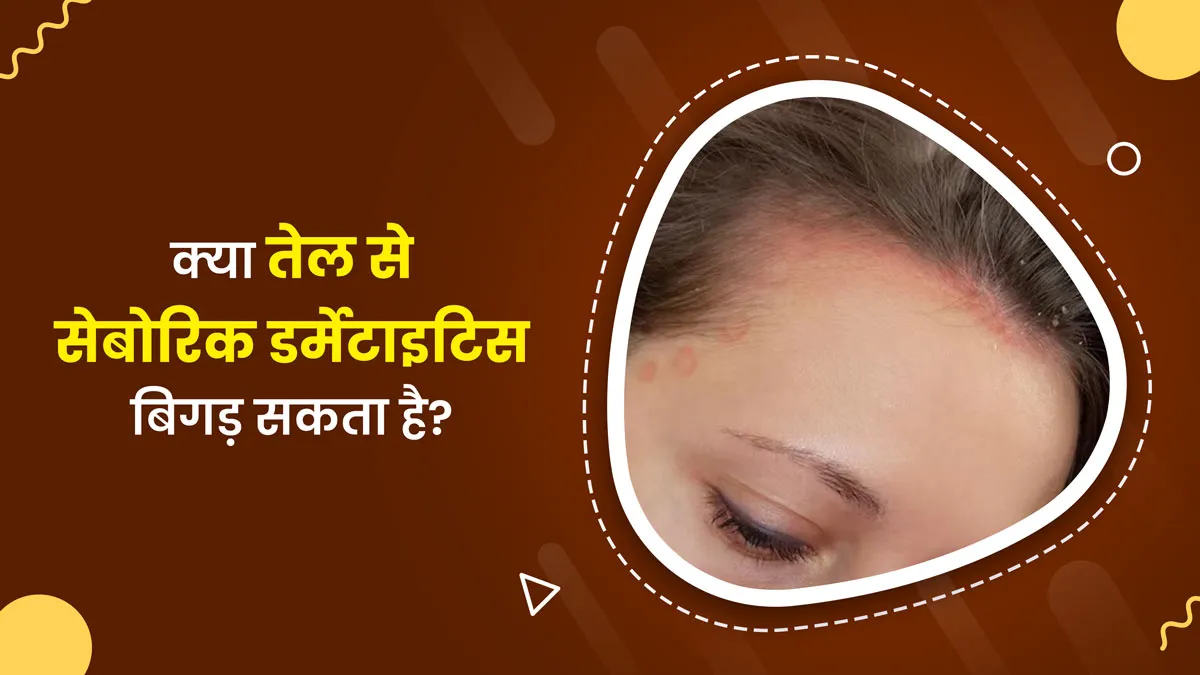 सेबोरिक डर्मेटाइटिस में तेल क्यों नहीं लगाना चाहिए? डॉक्टर से जानें ...