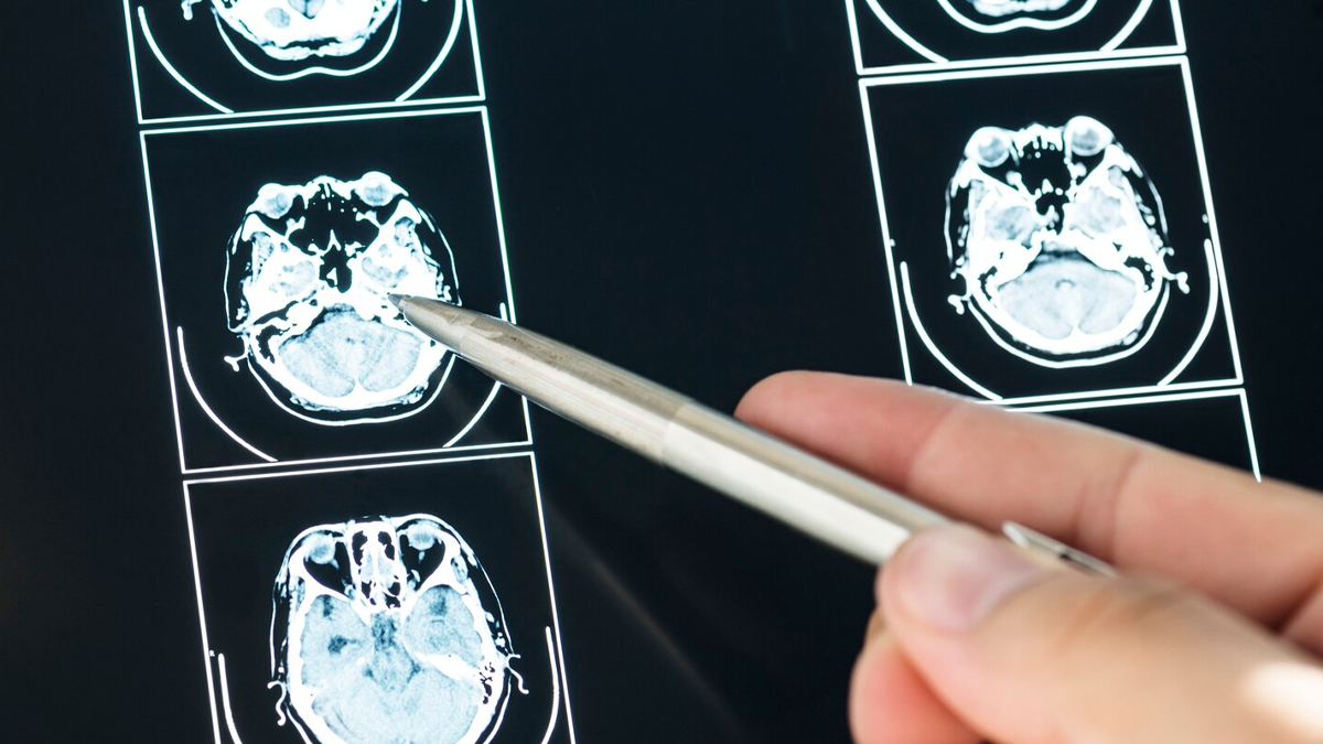 World Brain Tumor Day: ब्रेन ट्यूमर की पहचान कैसे होती है, जानें कौन से ...