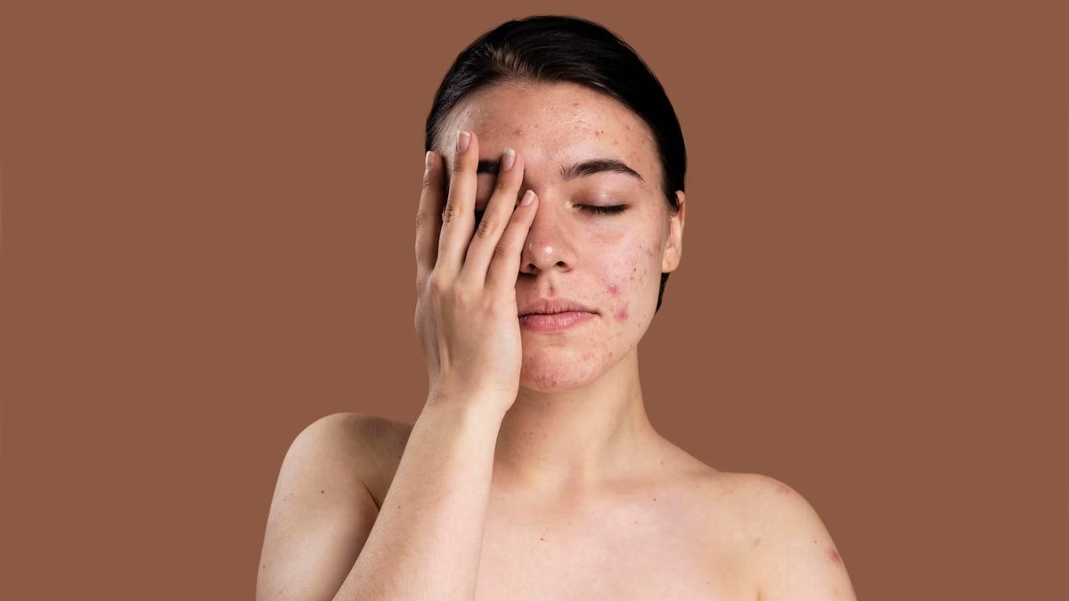 जिंक या सैलिसिलिक एसिड: आपकी स्किन टाइप के लिए मुंहासों से लड़ने वाला ...