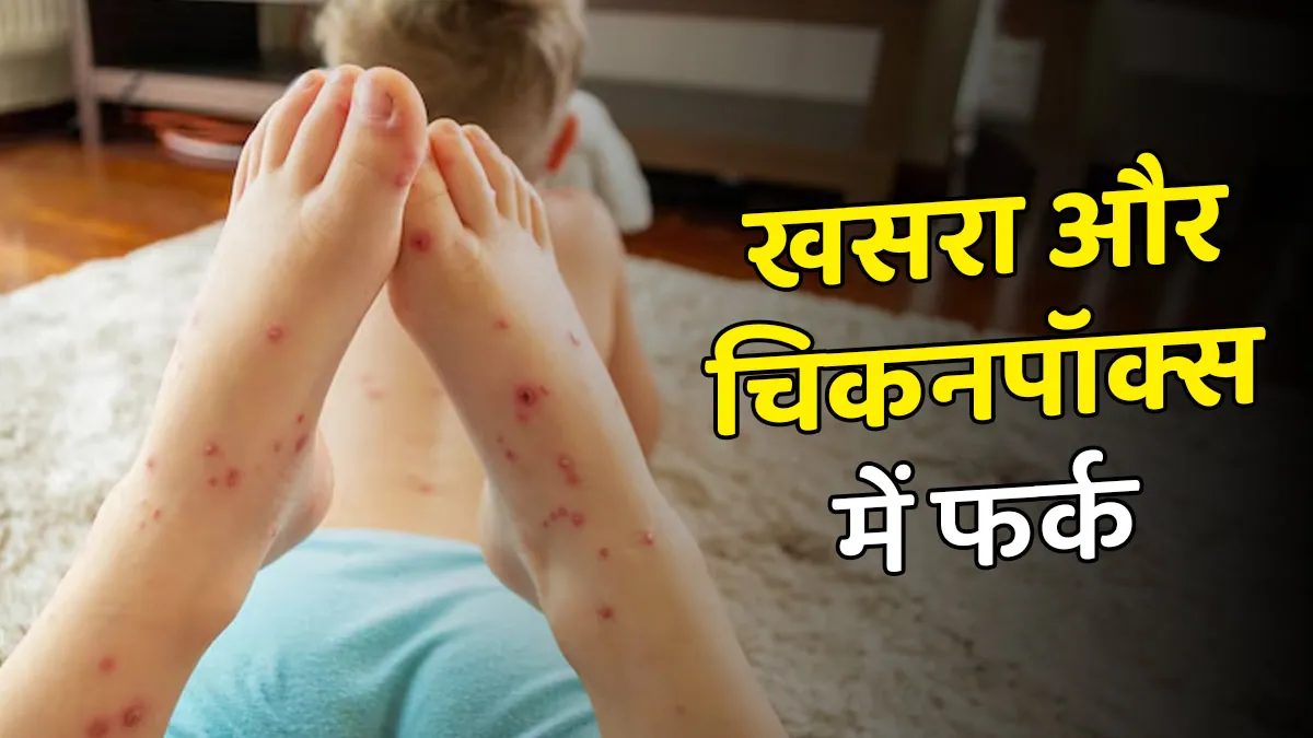 बच्चे के शरीर पर दाने निकलें तो कैसे पहचानें खसरा है या चिकनपॉक्स ...