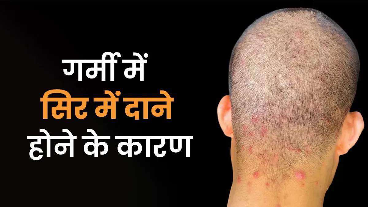 गर्मियों में सिर में दाने क्यों निकलते हैं? जानें कारण और बचाव के आसान ...
