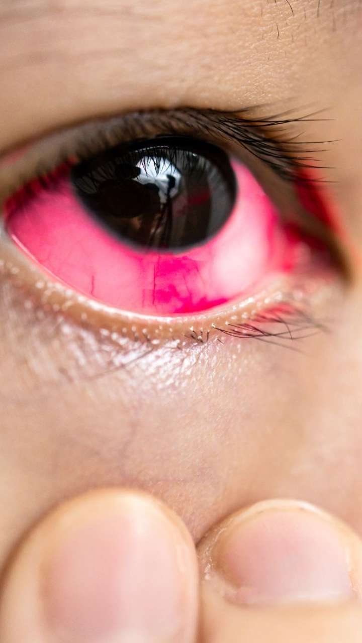 6 Warning Symptoms Of Viral Conjunctivitis Pink Eye Infection