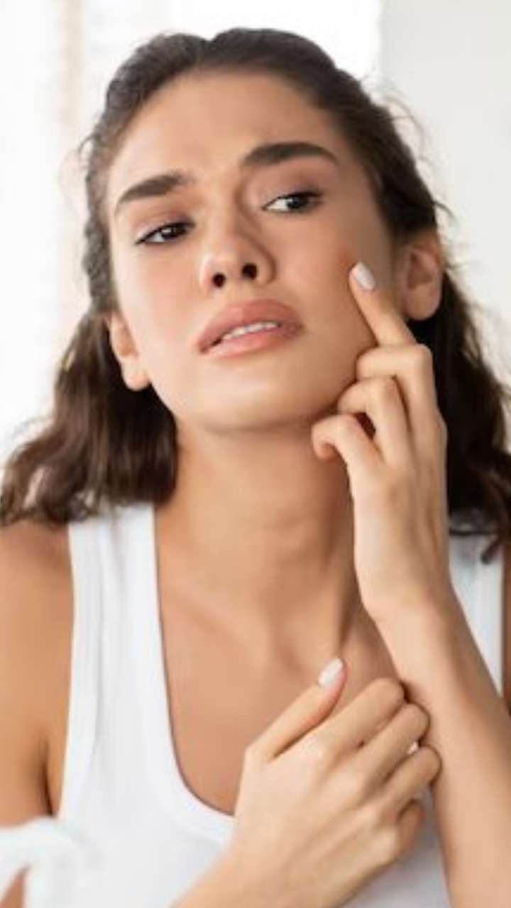 பருக்களை போக்கும் எளிய வழிகள் இவை தான் தெரியுமா?