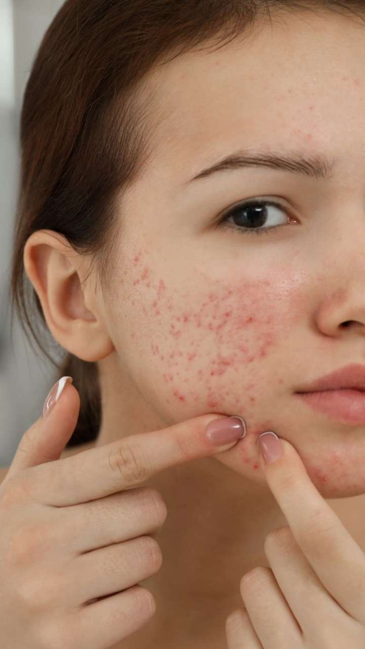 Here Are 6 Acne-Causing Foods That You Must Avoid For Clear Skin