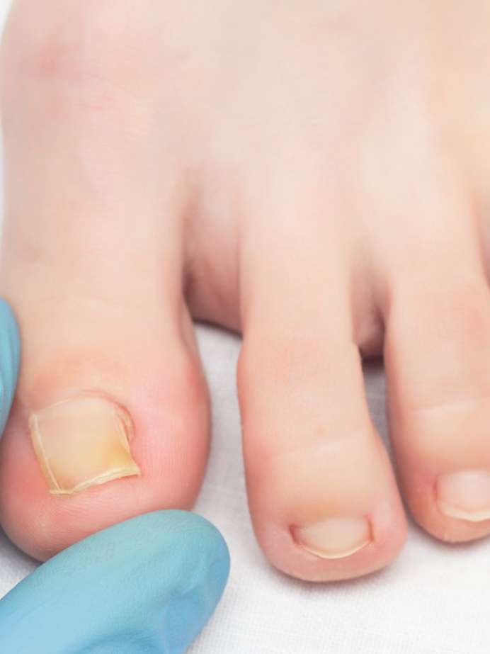 5 Things Yellow Nails Tell You About Your Health | Nail Health ...