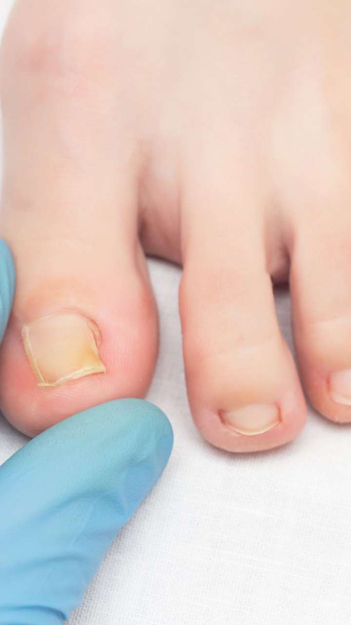 5 Things Yellow Nails Tell You About Your Health