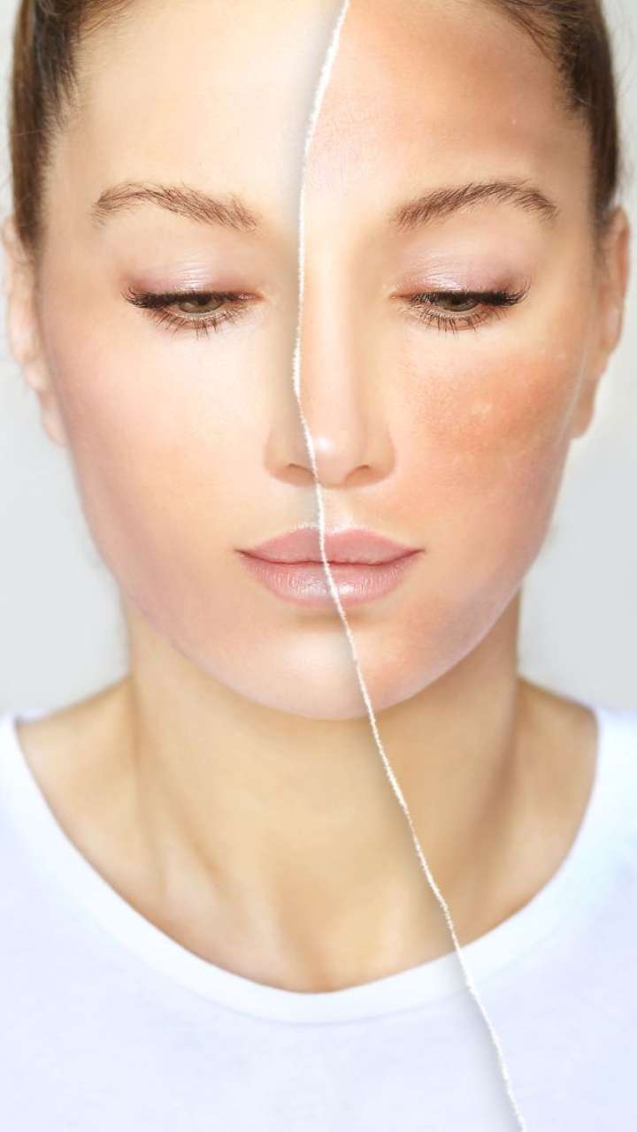 How To Take Care of Sun Damaged Skin Naturally