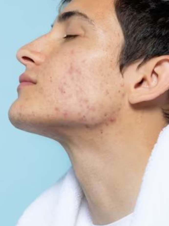 முகப்பருவை தவிர்க்க இந்த உணவுகளை சாப்பிடுங்கள்!