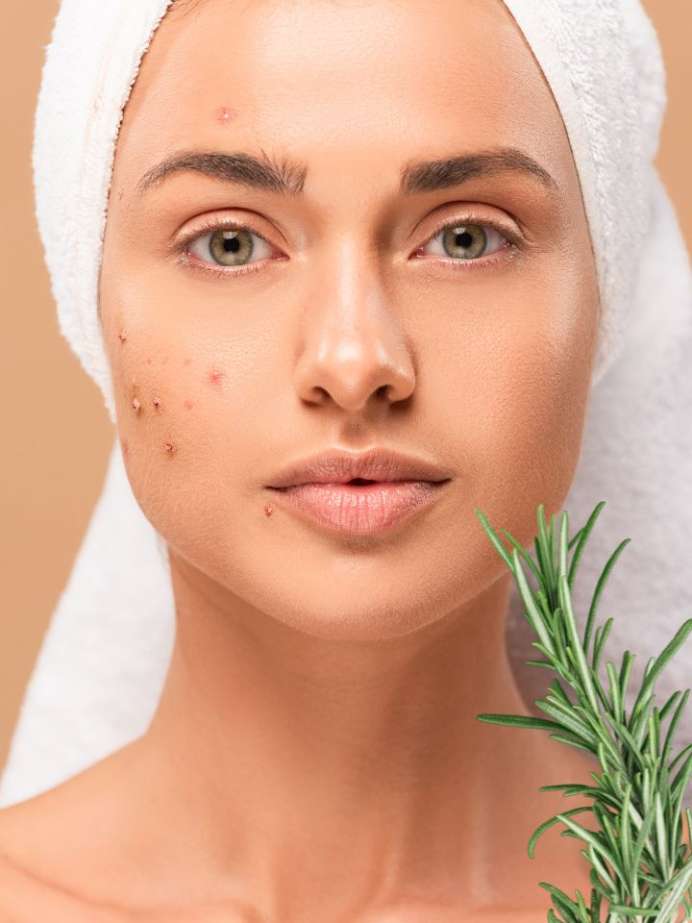 How To Make Rosemary Face Mask To Reduce Blemishes | Onlymyhealth