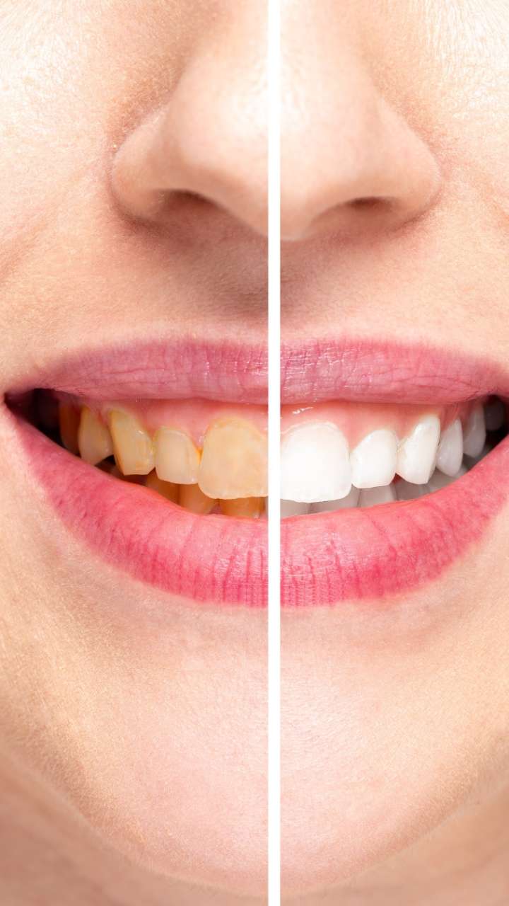 Home Remedies For Getting Rid Of Yellow Teeth