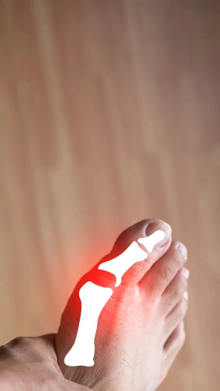 Best Home Remedies For Uric Acid