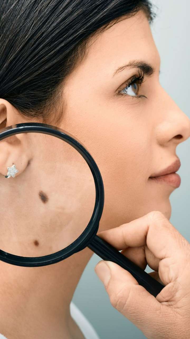 Early Warning Signs Of Skin Cancer