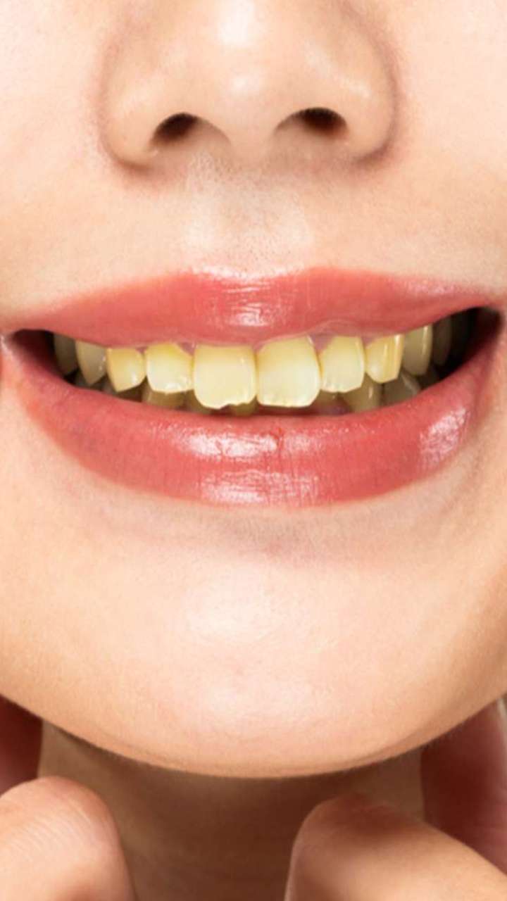 सरसों के तेल से इस तरह दूर होगा दांतों का पीलापन